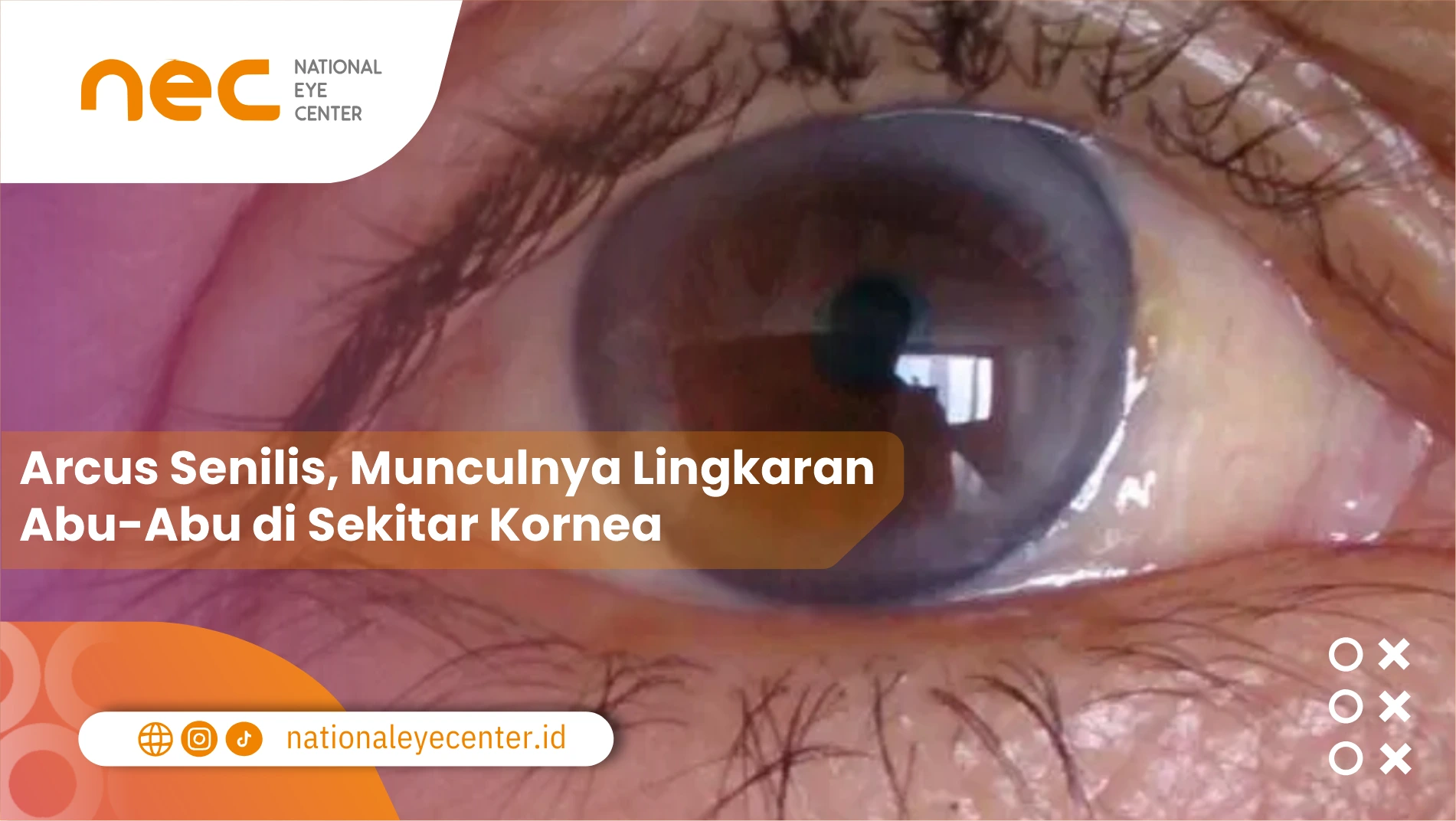 Arcus Senilis, Munculnya Lingkaran Abu-Abu di Sekitar Kornea