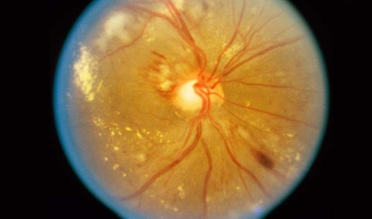 Retinopati Hipertensi - Gejala, Penyebab, dan Cara Mengobati