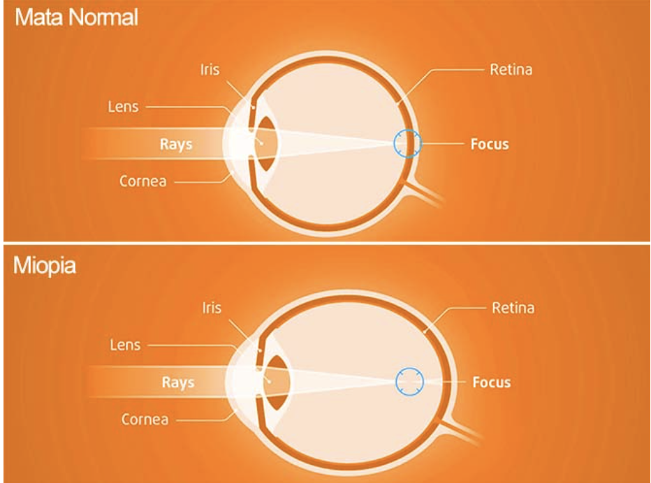 5 Cara Efektif Mencegah Mata Minus pada Anak