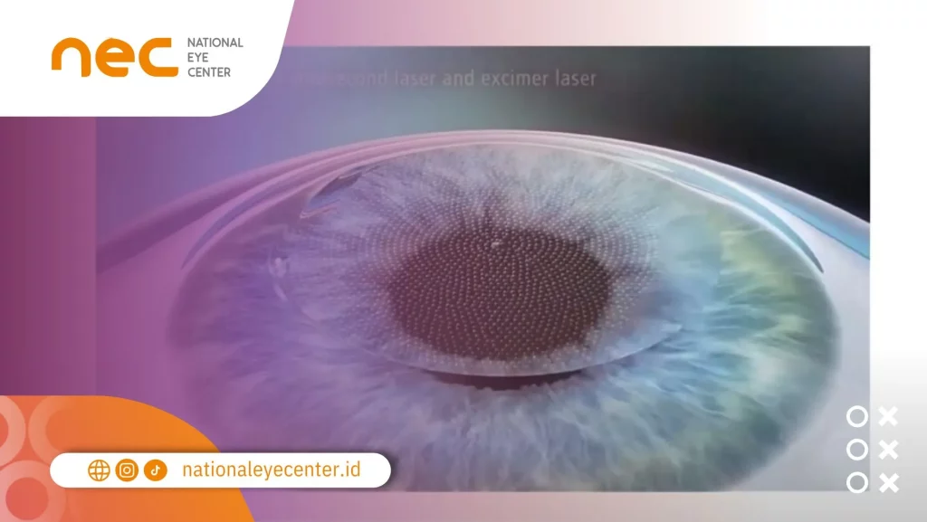 Semua Usia Bebas Lasik, NEC Menjadi Tempat Lasik Mata Terlengkap dan ...