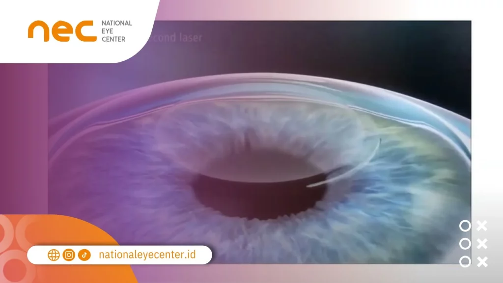 Semua Usia Bebas Lasik, NEC Menjadi Tempat Lasik Mata Terlengkap dan ...