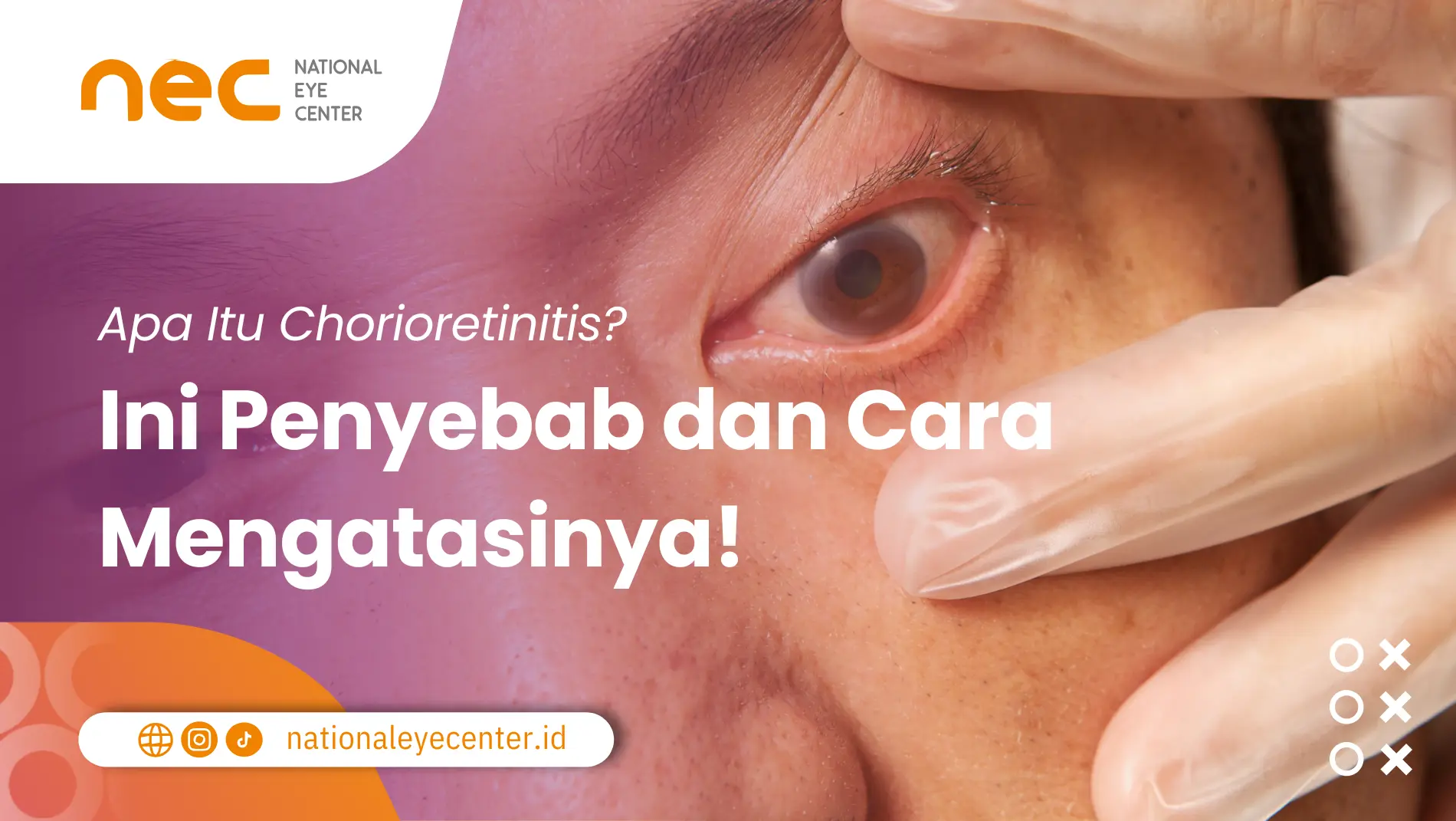 Apa Itu Chorioretinitis? Ini Penyebab dan Cara Mengatasinya!
