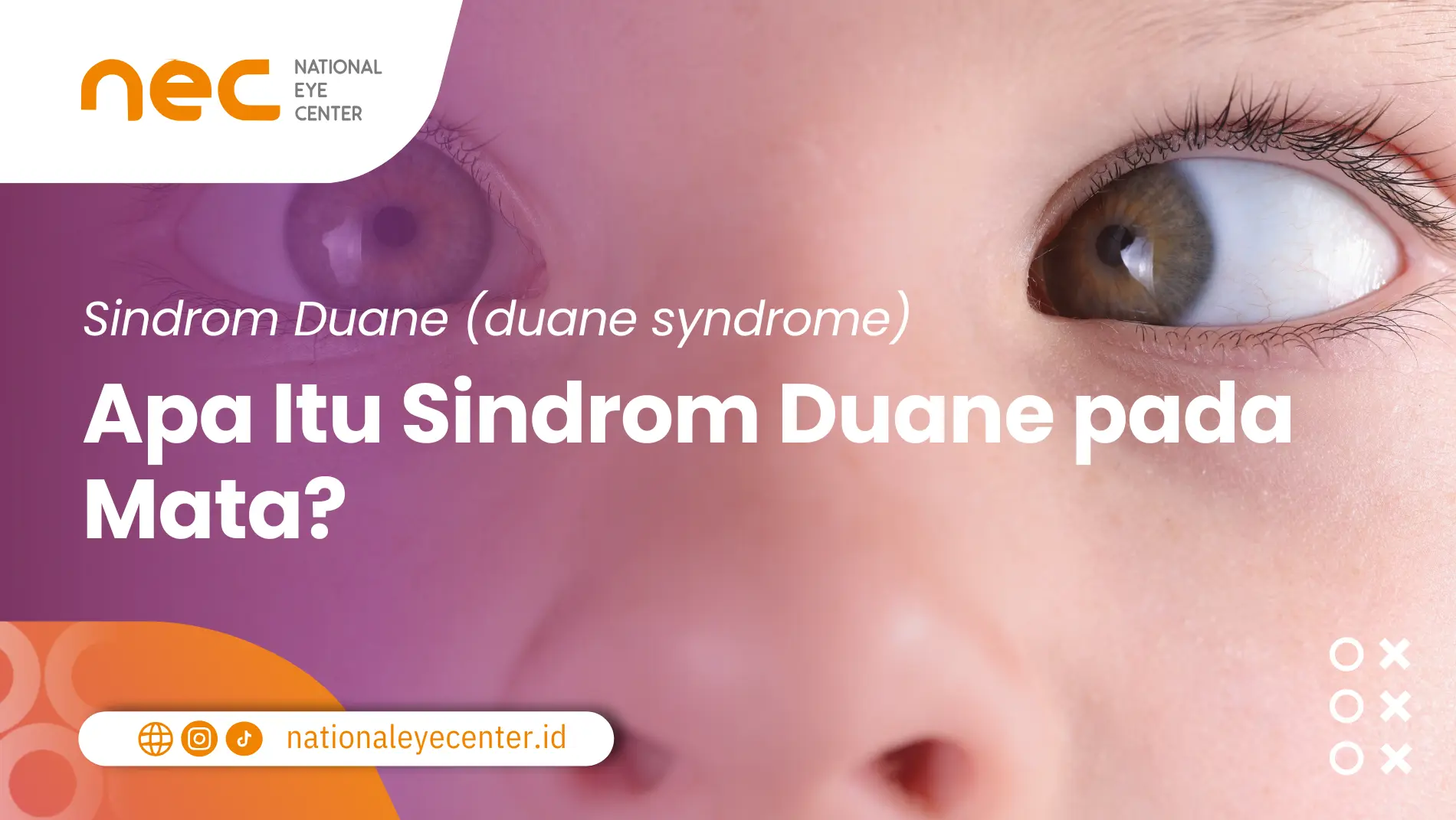 Apa Itu Sindrom Duane pada Mata?