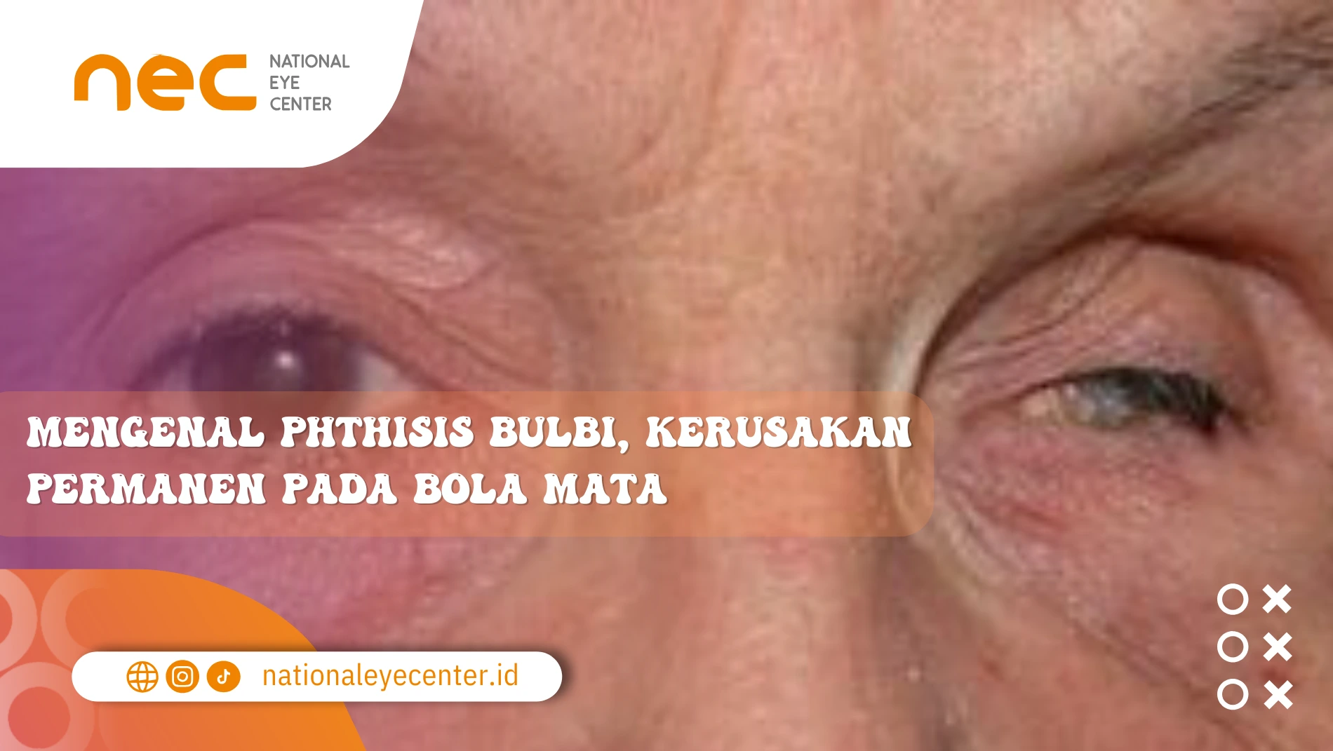 Mengenal Phthisis Bulbi, Kerusakan Permanen pada Bola Mata